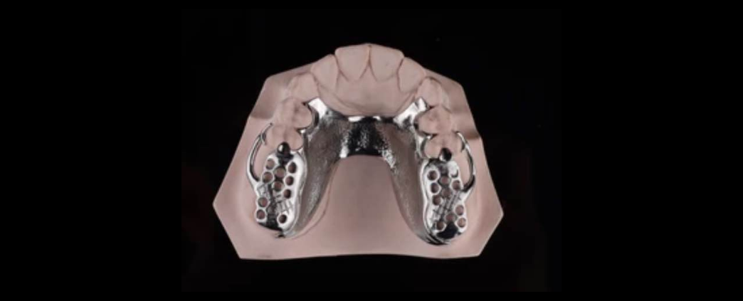 Unique and durable designs: metal bases in digital dentistry - SOi DIGITAL