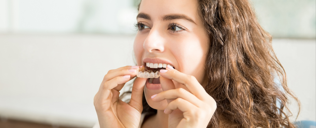 Dental Aligners 2023-2024: smarter and more personalized - SOi DIGITAL